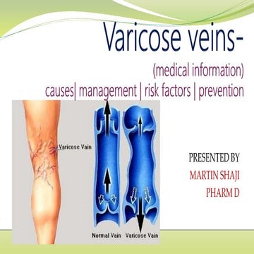 Varicose Veins; causes, symptoms and treatment.