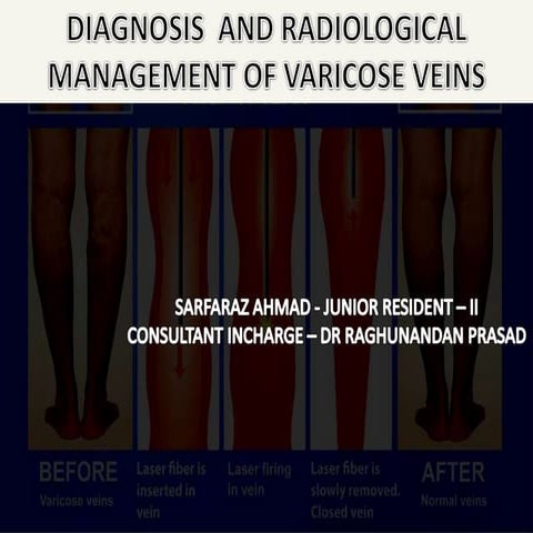 Diagnosis and radiological management of varicose vein | PPTX
