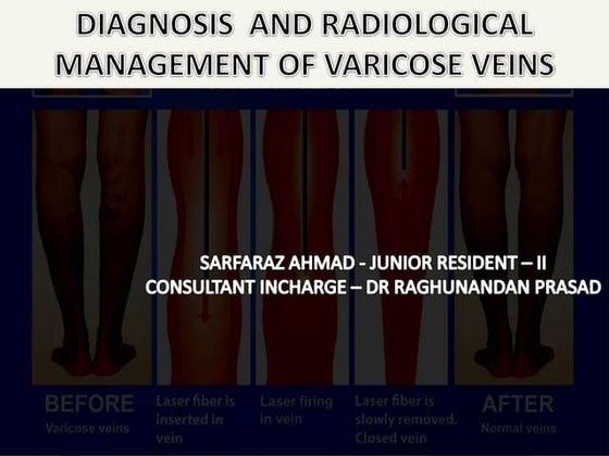 Varicose vein | PPTX