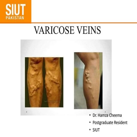 Varicose vein | PPTX