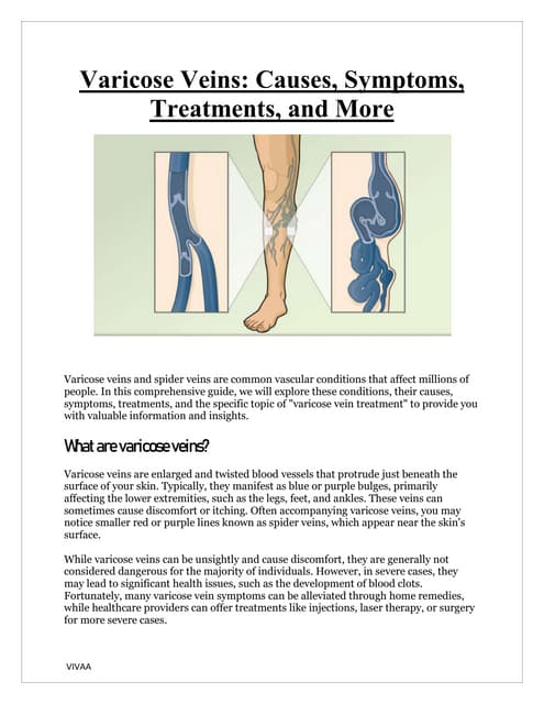 Varicose Veins Symptoms, Causes and Treatments | PPT