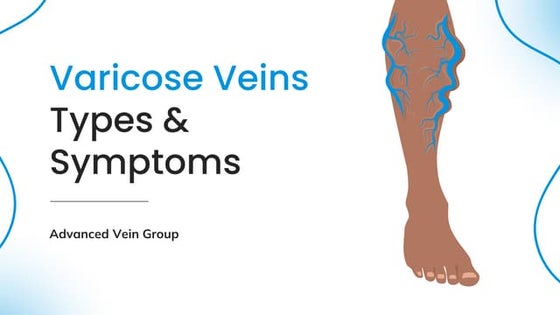 The Guide To Recognize The Signs And Symptoms Of Spider Veins | PDF