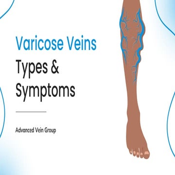 Varicose Veins Types & Symptoms | PPT