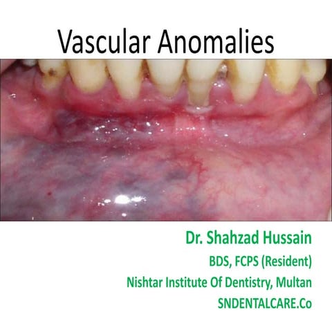 Vascular anomalies | PPTX