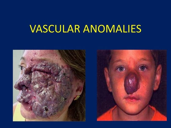 Vascular lesions in the head and neck regions | PPT
