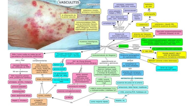Vasculitis