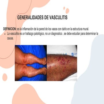 VASCULITIS.pptx