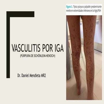 Vasculitis por IGA o purpura de henoch .... | PPTX