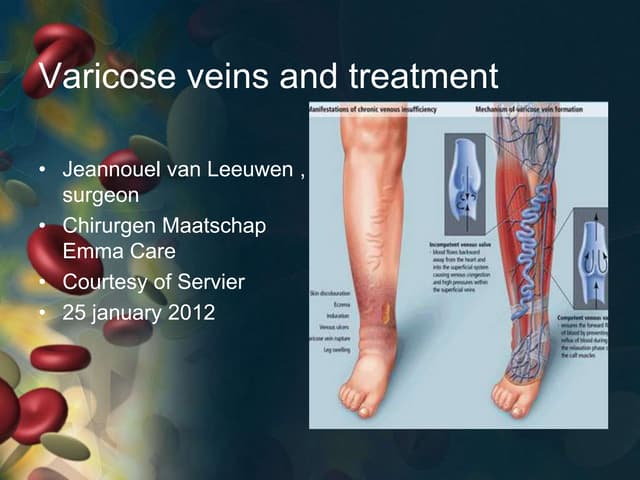 Case of Varicose Veins | PPTX
