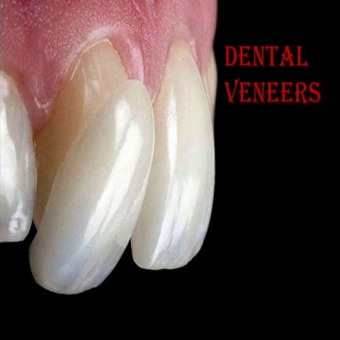 Veneers in conservative dentistry and endodontics | PPTX