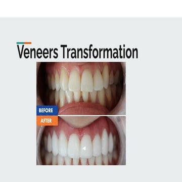 Veneers Transformation.pdf