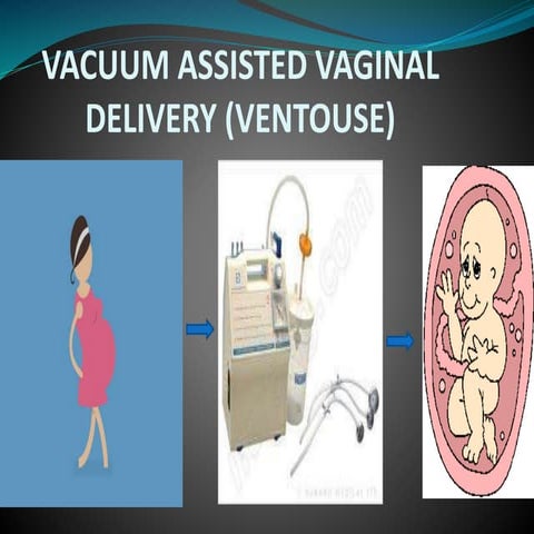 Vacuum Delivery | PPTX