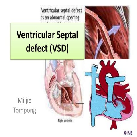 Ventricular septal defect (vsd) | PPTX