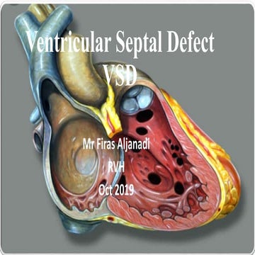 VENTRICULAR SEPTAL DEFECT | PPT