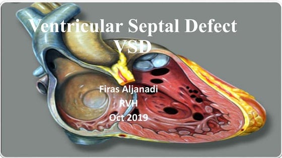 VENTRICULAR SEPTAL DEFECT by sherif ahmed | PPT