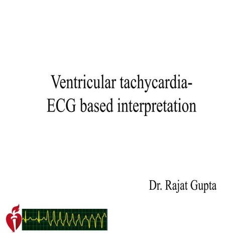 Ventricular tachycardia- ECG based approach | PPTX