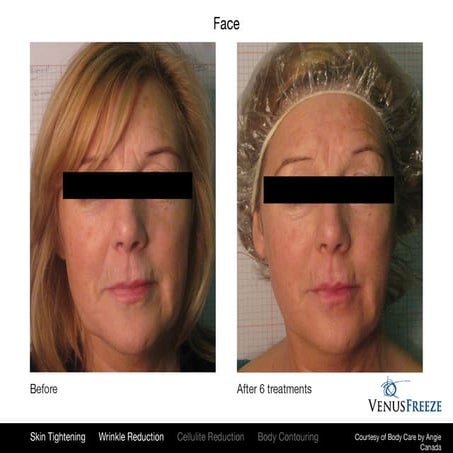 Venus Freeze Before and After Photos | PDF