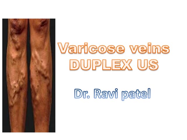 Anatomy, Physiology & Classification of Varicose Veins | PDF
