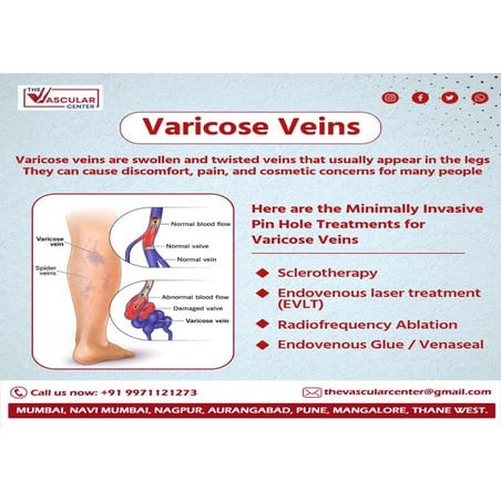 Varicose Veins- The Vascular Center | PDF