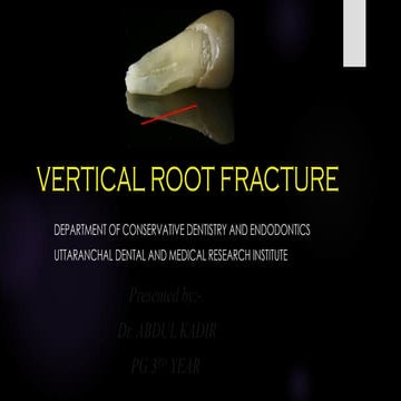 true’’ VRF is defined as a longitudinally oriented complete or ...