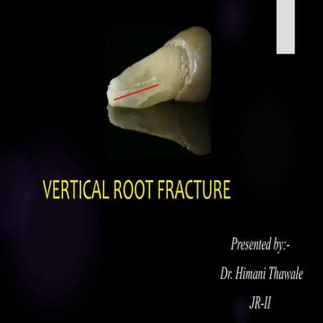 Vertical root fracture | PPTX