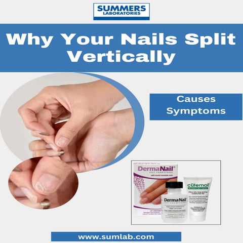 What deficiency causes nails to split vertically? | PDF