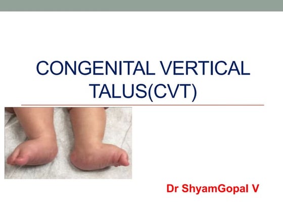 Valgus vs. Varus | PPTX