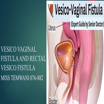 Urinary Tract Fistulas -(VVF) Etiology, Diagnosis, Management | PDF