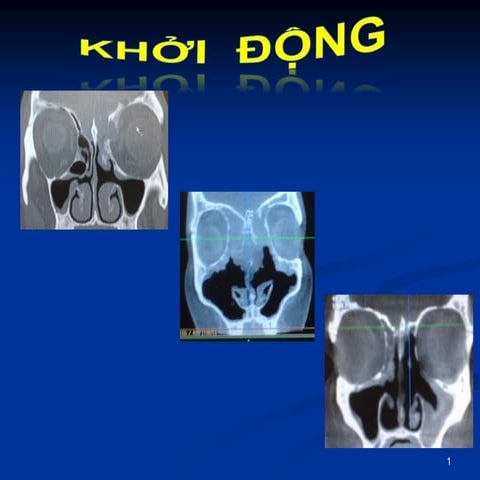 Viêm mũi dị ứng - Lớp YHGD.ppt