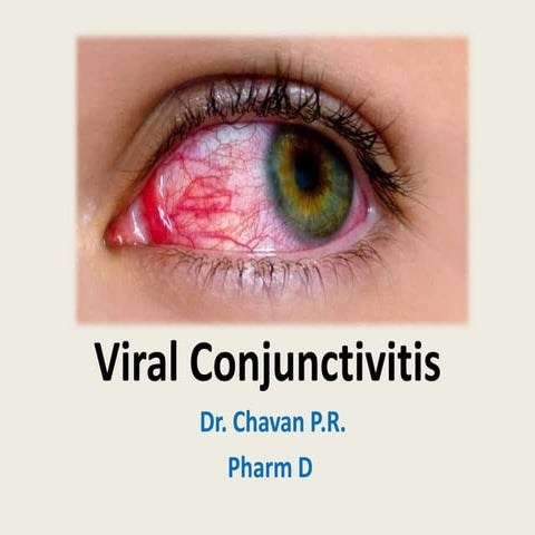 Viral conjunctivitis basic overview | PPTX