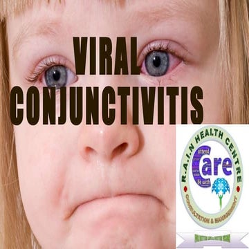 Viral conjunctivitis | PPTX