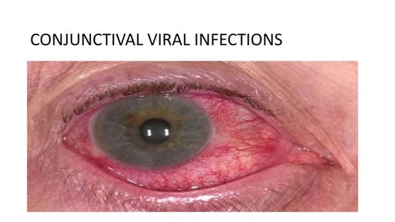 09Conjunctival Infections.ppt