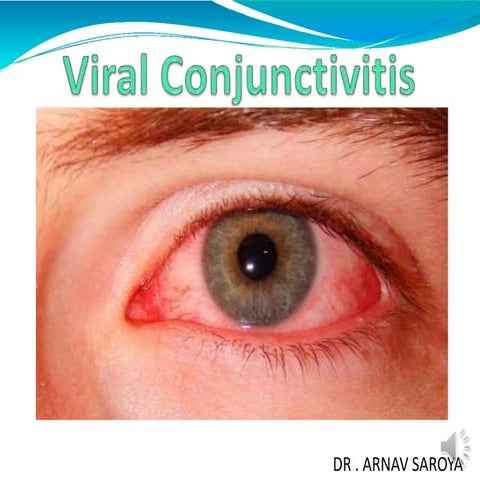 Viral conjunctivitis - DR ARNAV | PPTX