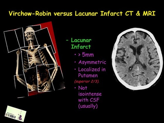 Spinal tuberculous leptomeningitis & subdural empyema & lately ...