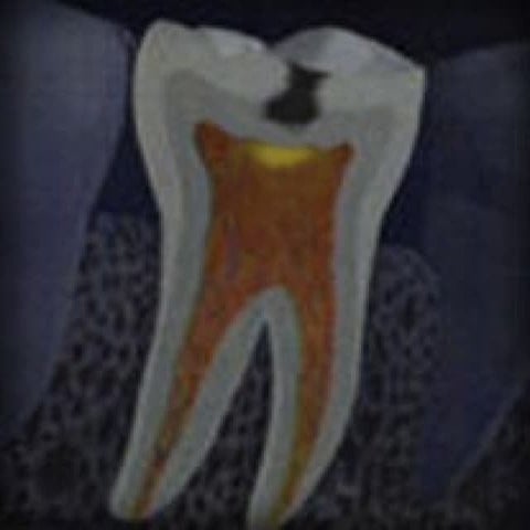 Pulp protection in operative dentistry | PPTX