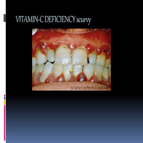 Vitamin c deficiency scurvy | PPTX