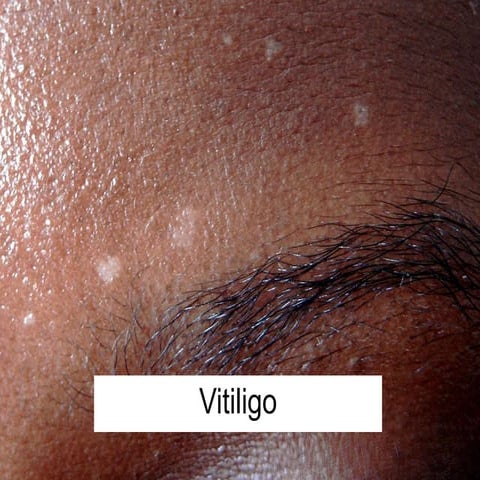 Vitiligo | PPTX | Skin and Dermatology | Diseases and Conditions