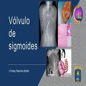 Vólvulo de sigmoides.pptx