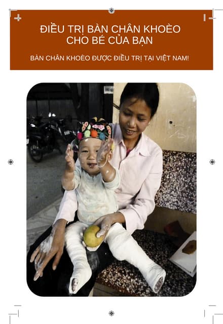 Clubfoot vn brochure(poster) | PDF