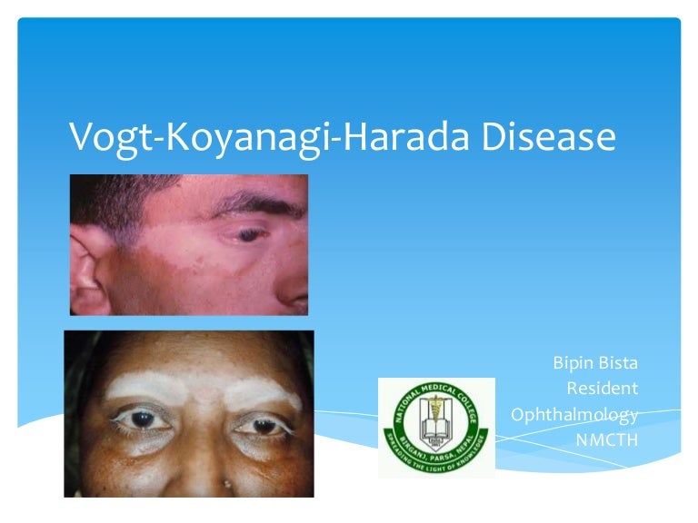 Vogt koyanagi-harada disease