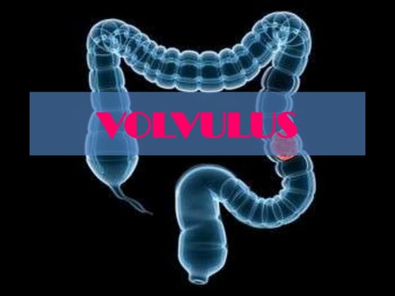 Meckel's diverticulum | PPT