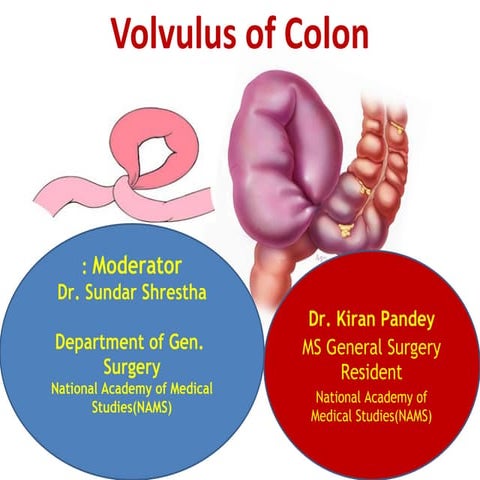 volvulusofcolon surgical by Abbas Kareem | PPT