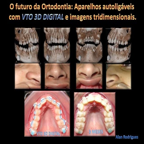 ORTODONTIA AUTOLIGÁVEL COM VTO 3D DIGITAL | PPTX