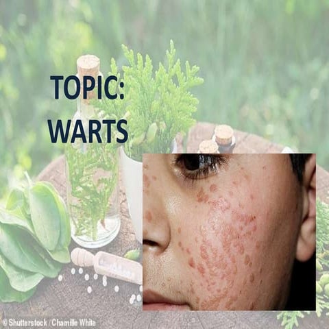 Warts | PDF