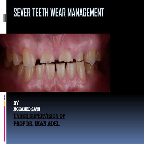 Sever teeth Wear Management By Mohamed Sawi.pptx