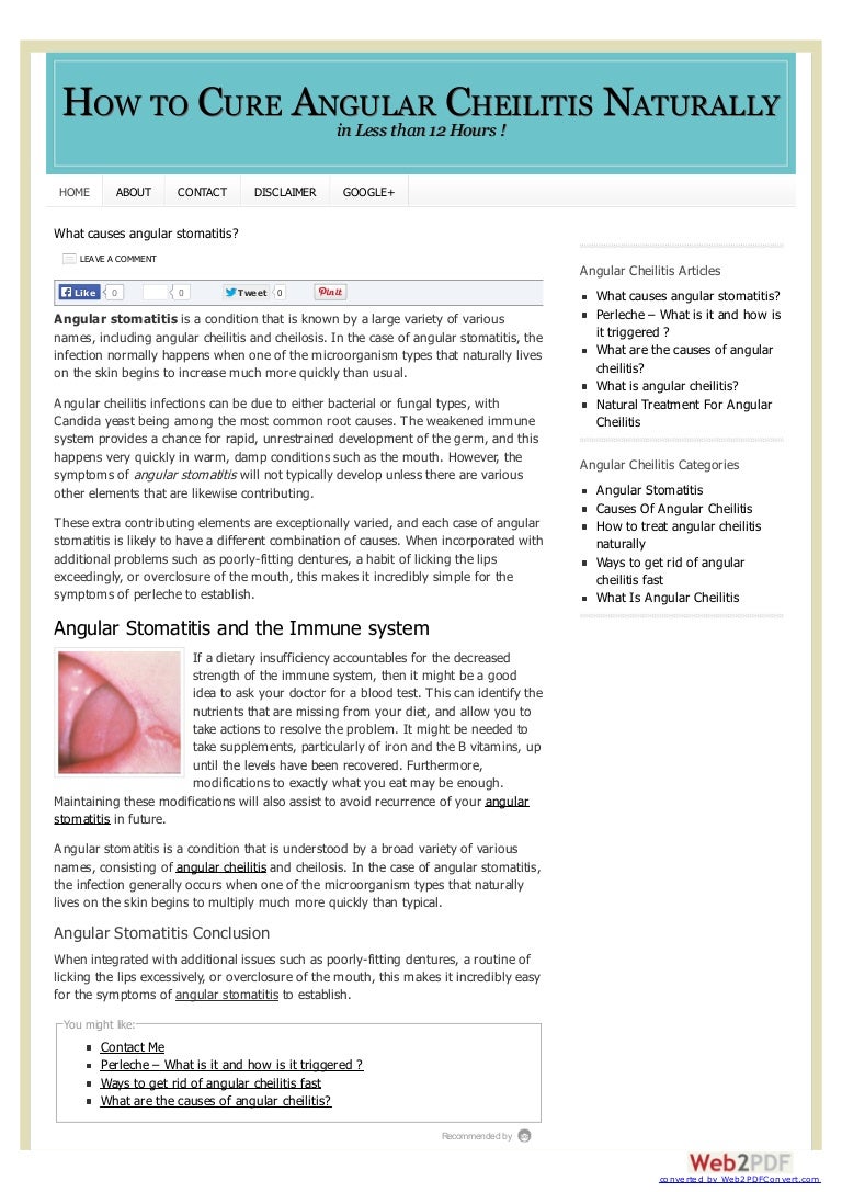 Angular Cheilitis Causes Symptoms Diagnosis Treatment