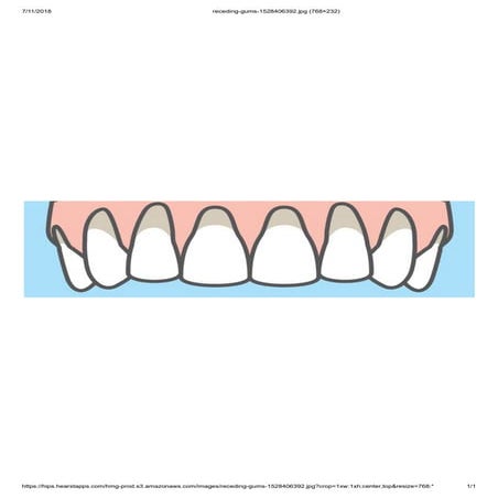 What do receding gums look like | PDF