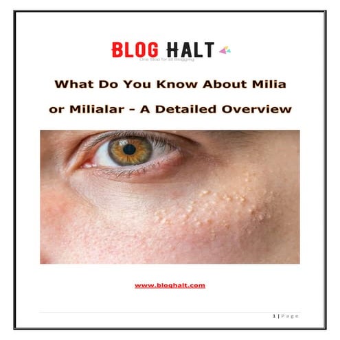 What Do You Know About Milia or Milium - A Detailed Overview.pdf