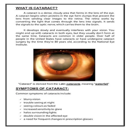 Cataract Definition The BEST Cataract Surgery Lenses Options Doctor