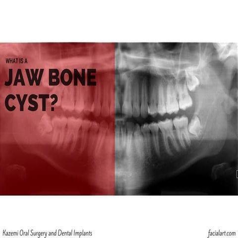 What is a Jaw Bone Cyst? | PDF